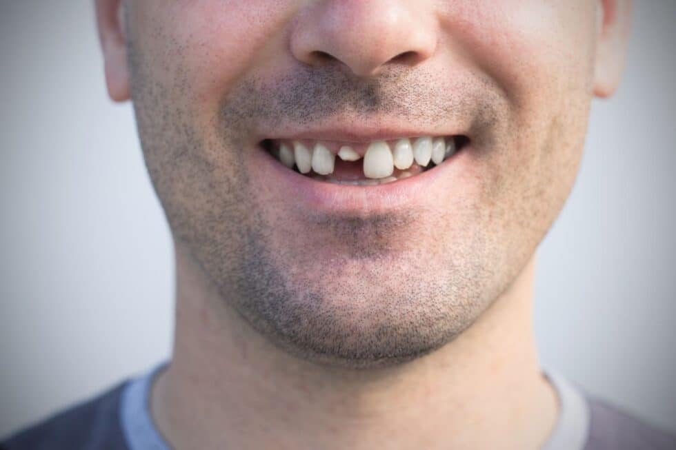 Top 5 Treatments for Fixing a Broken Front Tooth - Asha Dental
